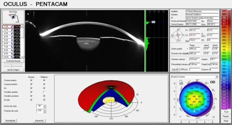 OCULUS Pentacam HR - Ophthalmicmart