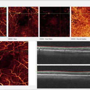 Optovue AngioVue OCT and OCTA Imaging System