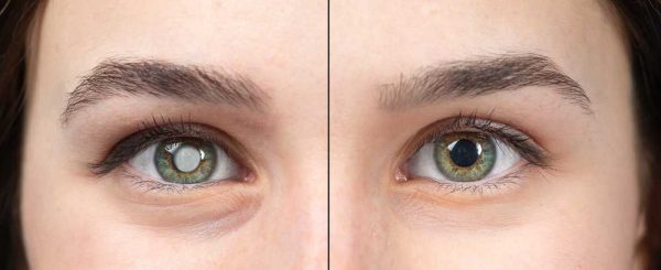 5 Major Challenges In Ophthalmology In Developing Countries